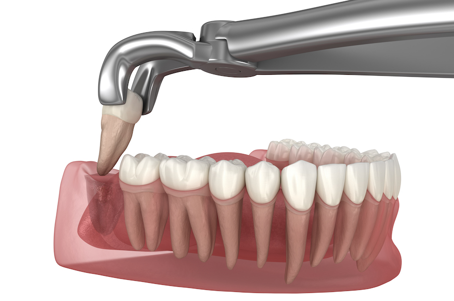 Wisdom Tooth Surgery in Thomson Singapore